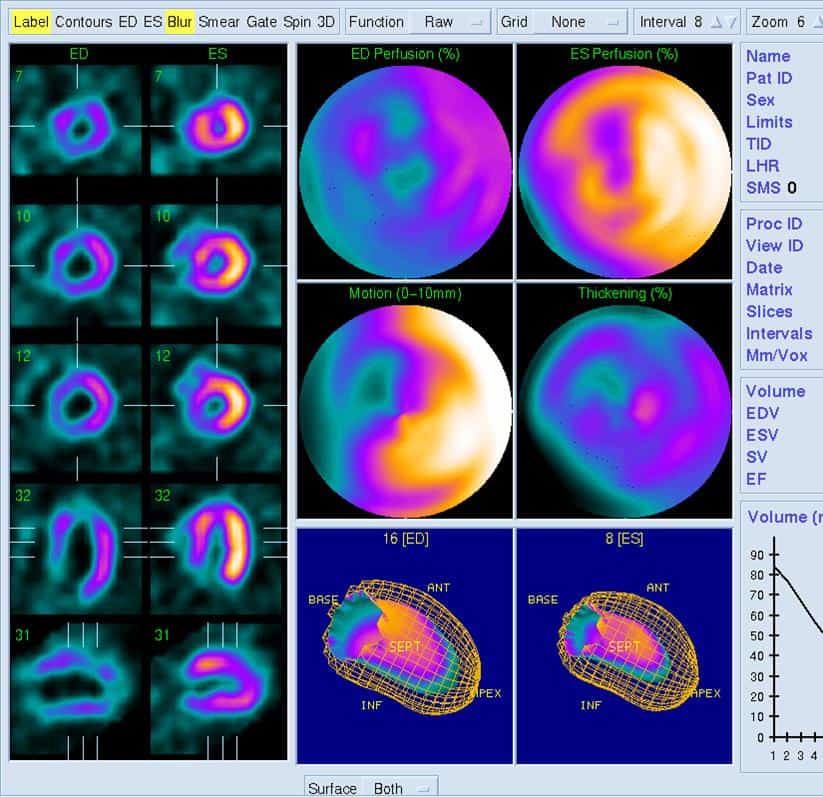 Myocardial Perfusion Scanning Dr Diana Holdright