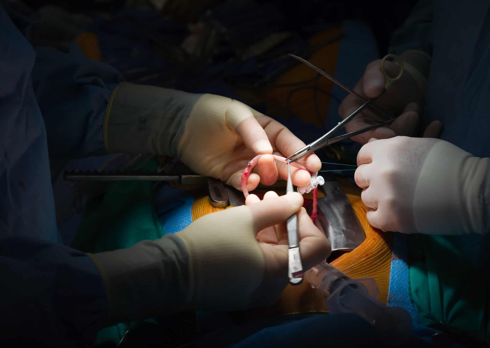 Coronary artery Bypass Surgery - Dr Diana Holdright