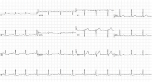 ECG Monitoring - Dr Diana Holdright
