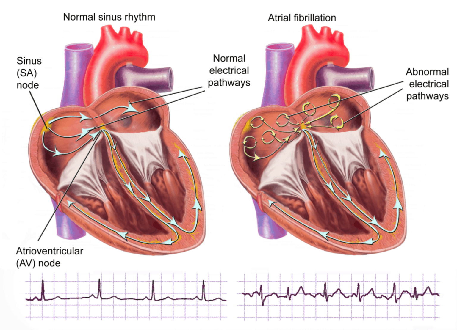 Atrial Fibrillation - Dr Diana Holdright